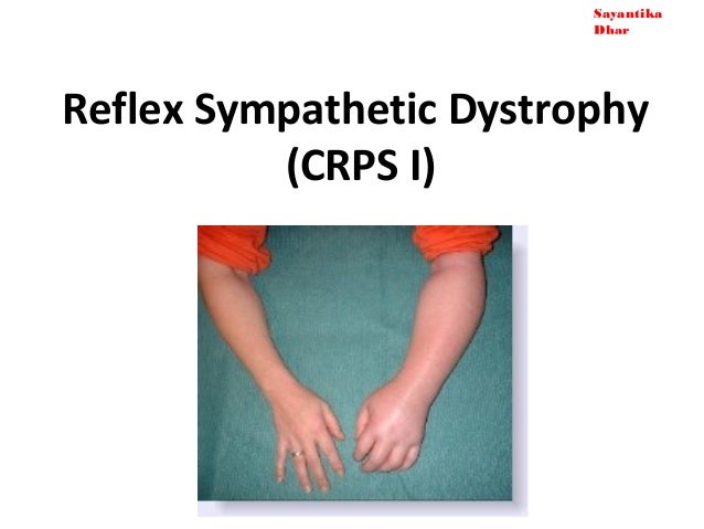 Reflex Sympathetic Dystrophy (CRPS 1)