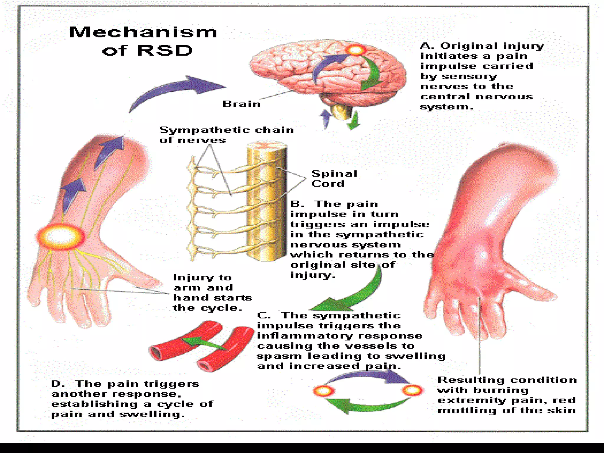 Crps | PPT | Physical Therapy | Wellness