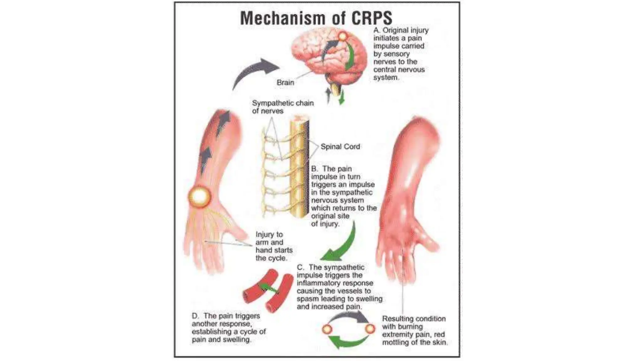 All about Complex Regional Pain Syndrome.pptx