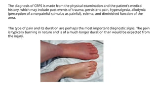 Complex regional pain syndrome (CRPS) by Dr Samarth | PPT