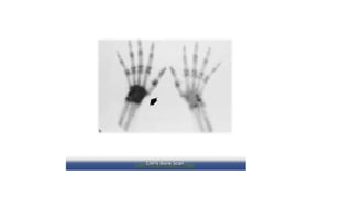 Complex regional pain syndrome (CRPS) by Dr Samarth | PPTX