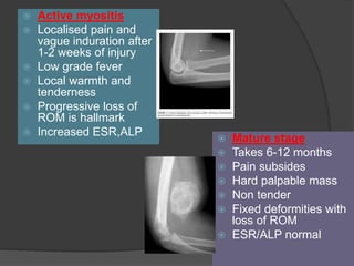 CRPS/ SUDECKS DYSTROPHY & MYOSITIS OSSIFICANS | PPTX