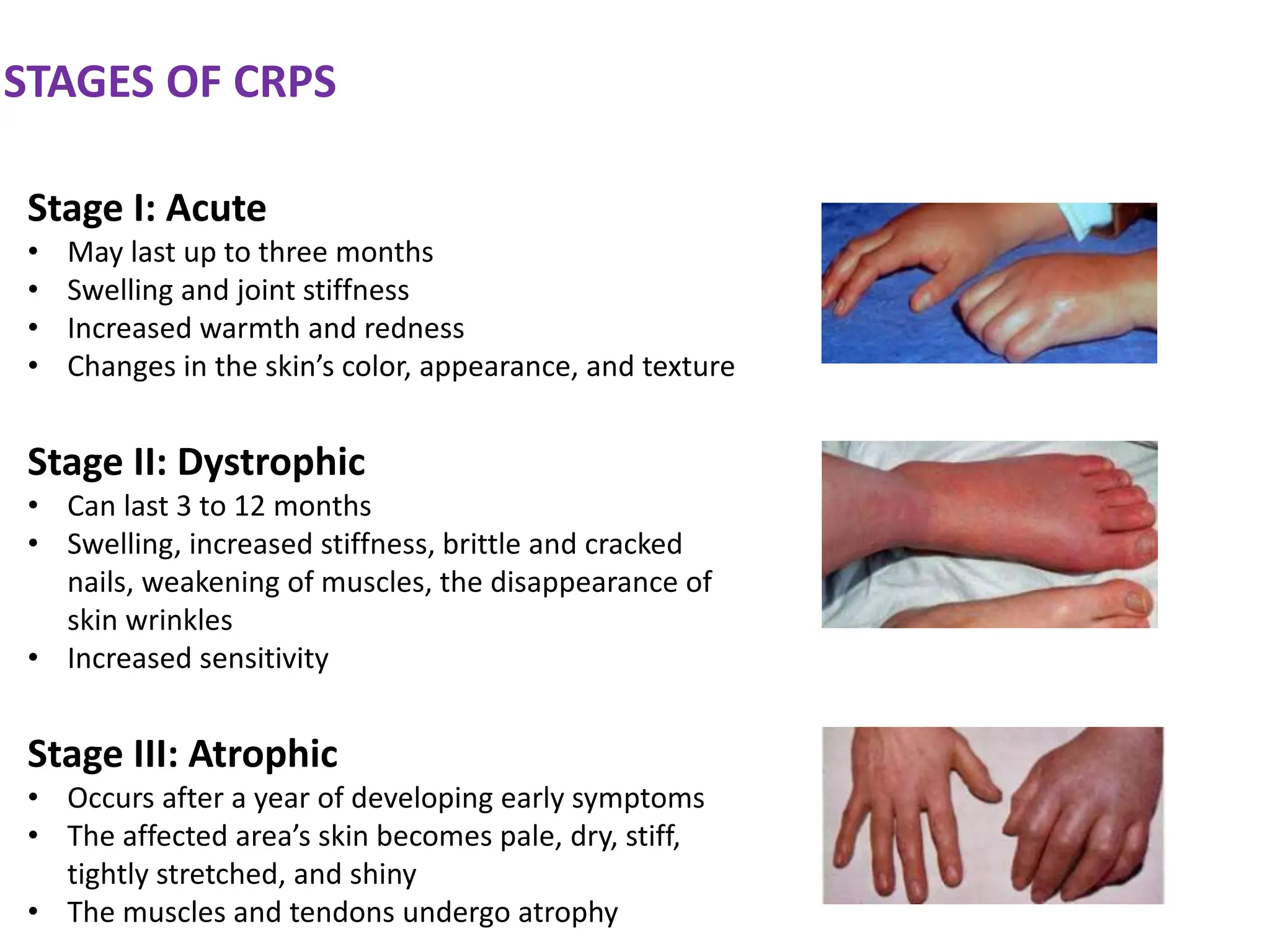CRPS ( Complex regional pain syndrome ) | PPT