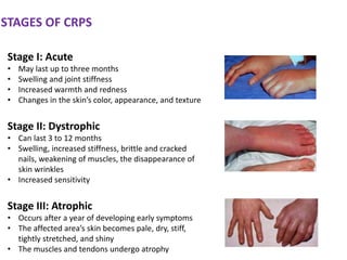CRPS ( Complex regional pain syndrome ) | PPT