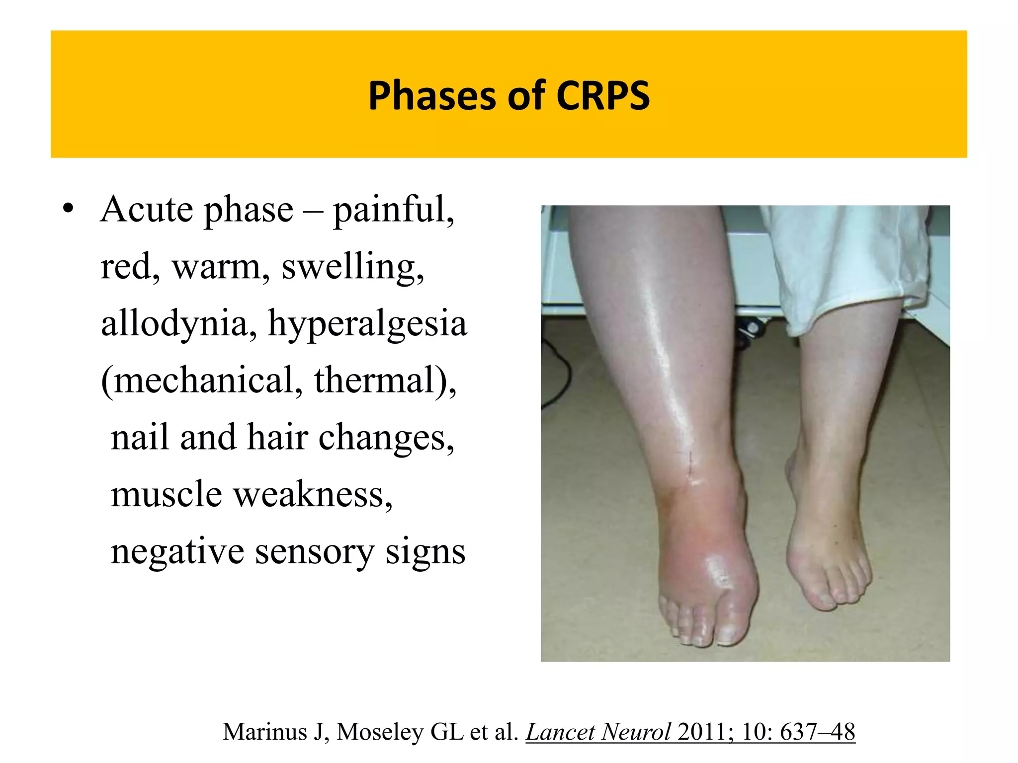 Complex Regional Pain Syndrome - Dr Venugopal Kochiyil | PPTX