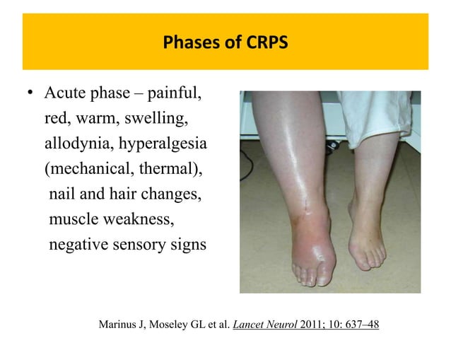 Complex Regional Pain Syndrome - Dr Venugopal Kochiyil | PPTX | Physical Therapy | Wellness