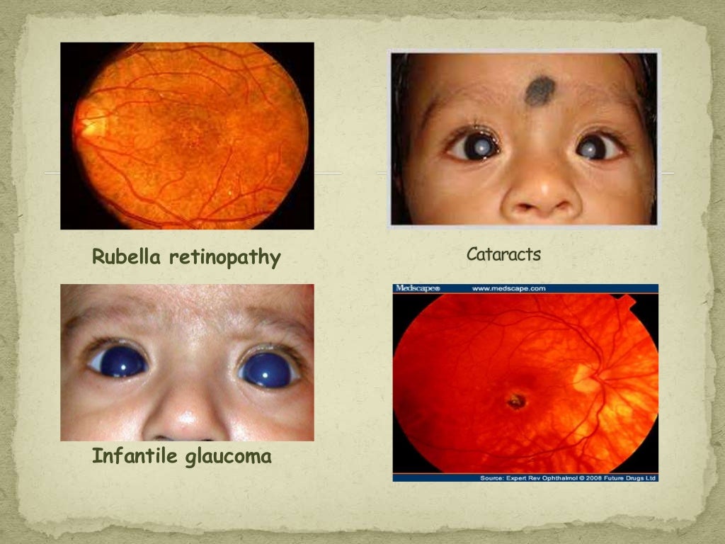 Congenital rubella syndrome