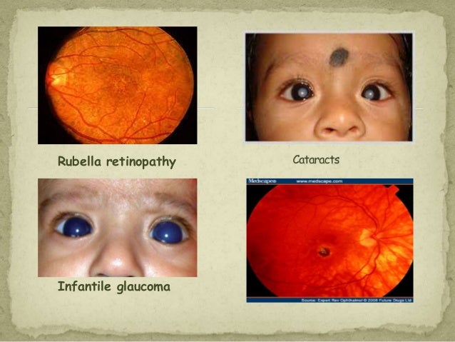 Congenital rubella syndrome