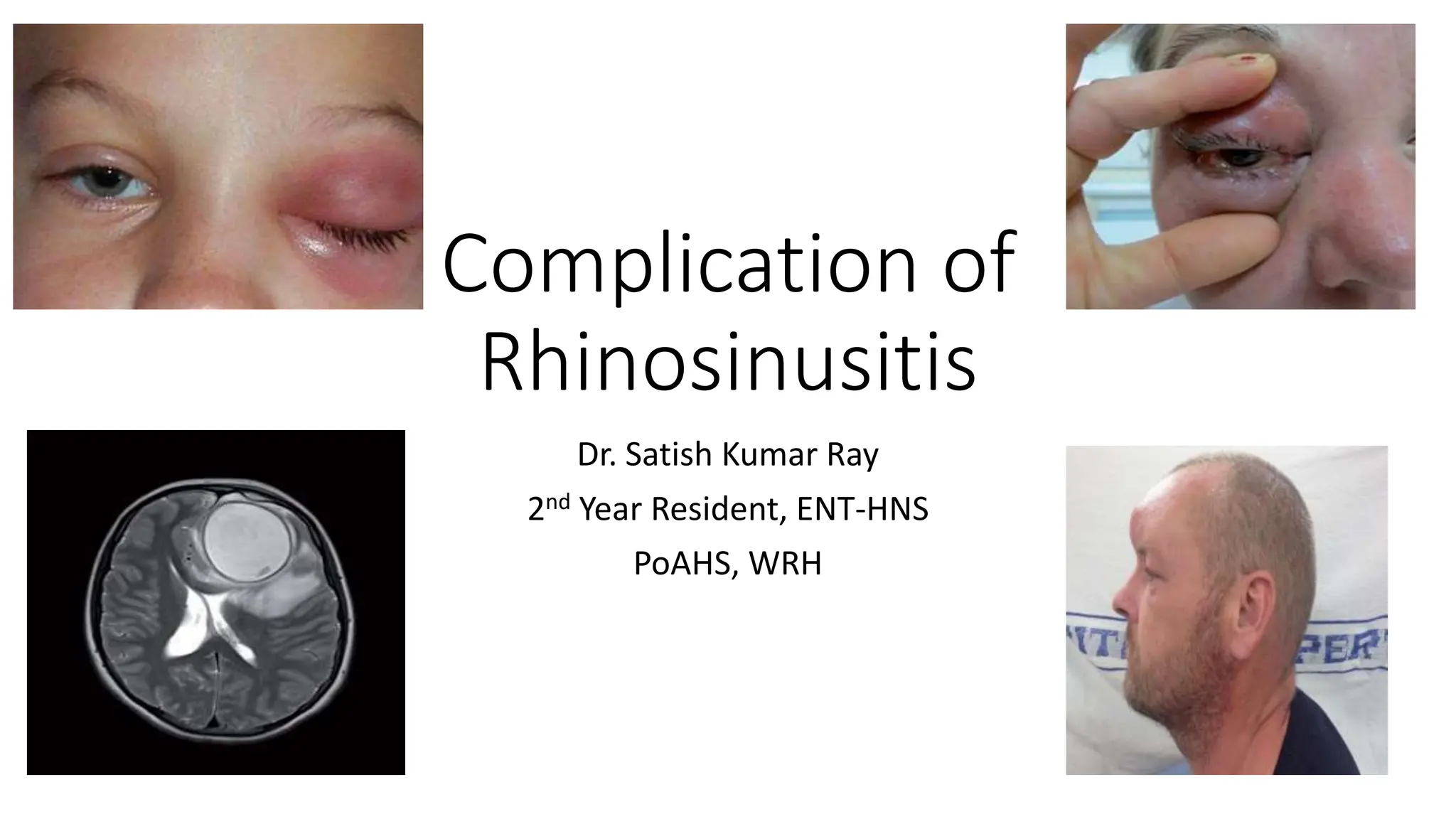 CHRONIC RHINOSINUSITIS complications ENT-HNS.pptx
