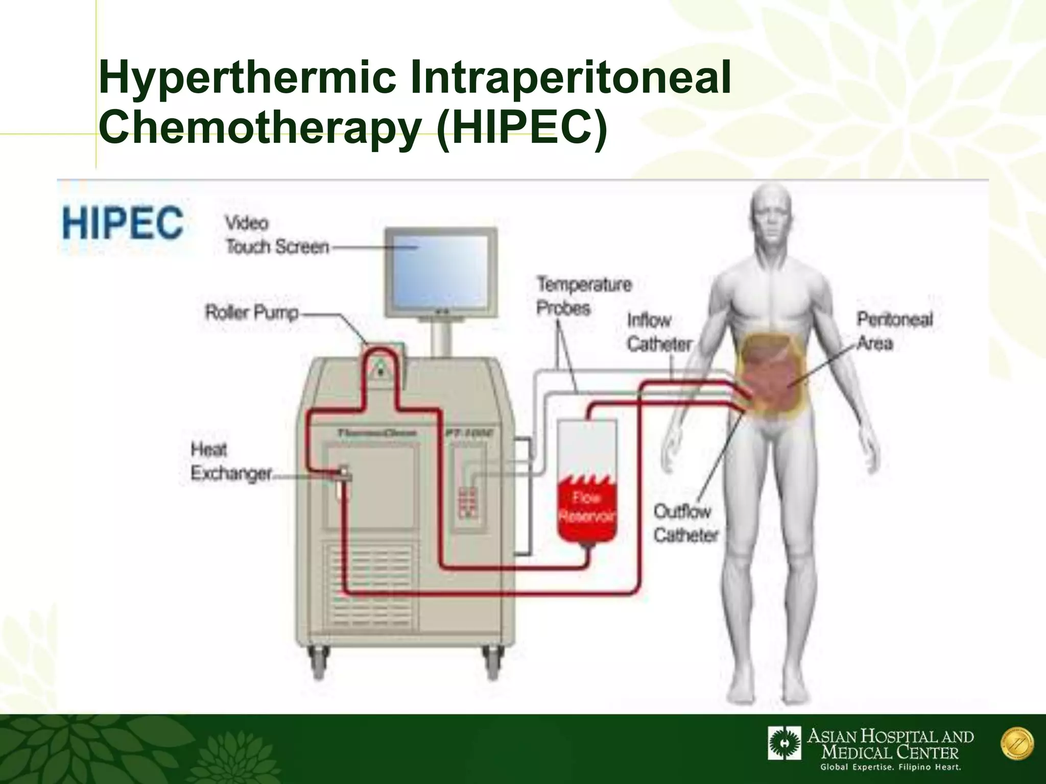 Hyperthermic Intraperitoneal Chemotherapy for Peritoneal Surface ...