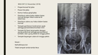 CRS - Nefrolithiasis.pptxxxxxxxxxxxxxxxxxxxxxxxxxxxxxxxxxxxxxxxxxx | PPTX
