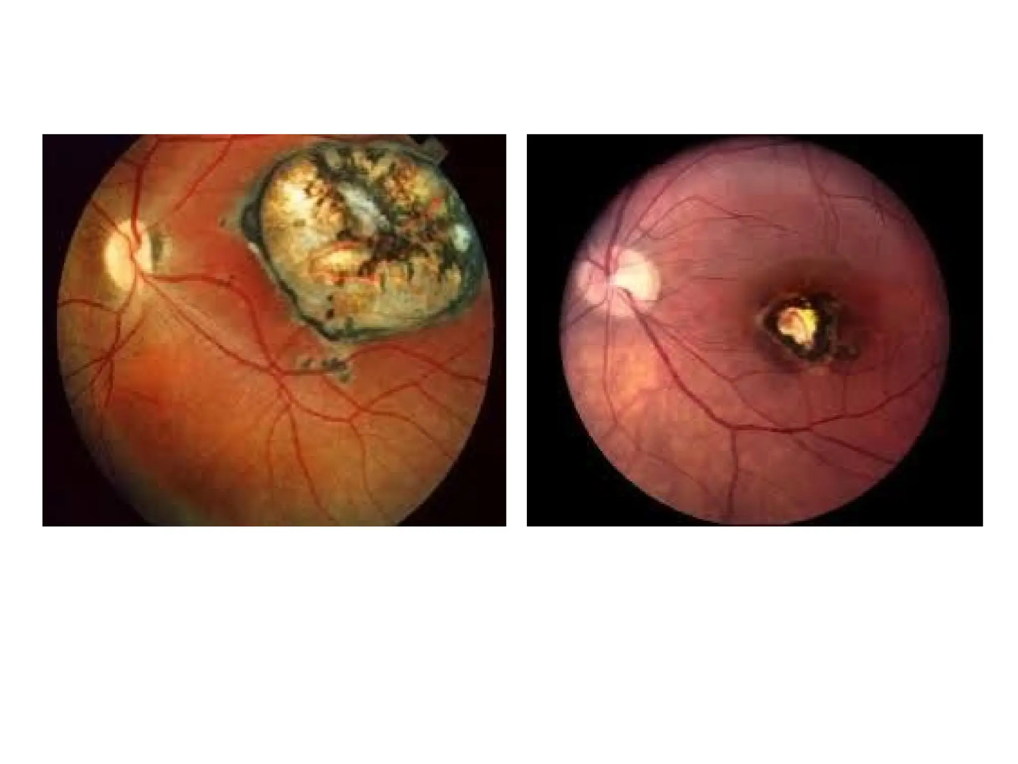 retinal scar case presentation by one of | PPTX