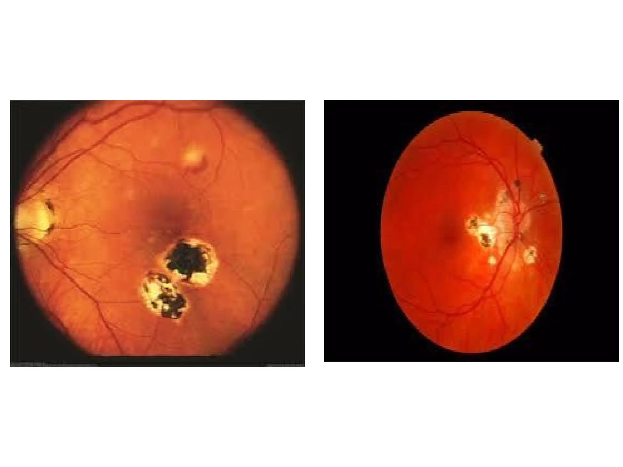 retinal scar case presentation by one of | PPTX