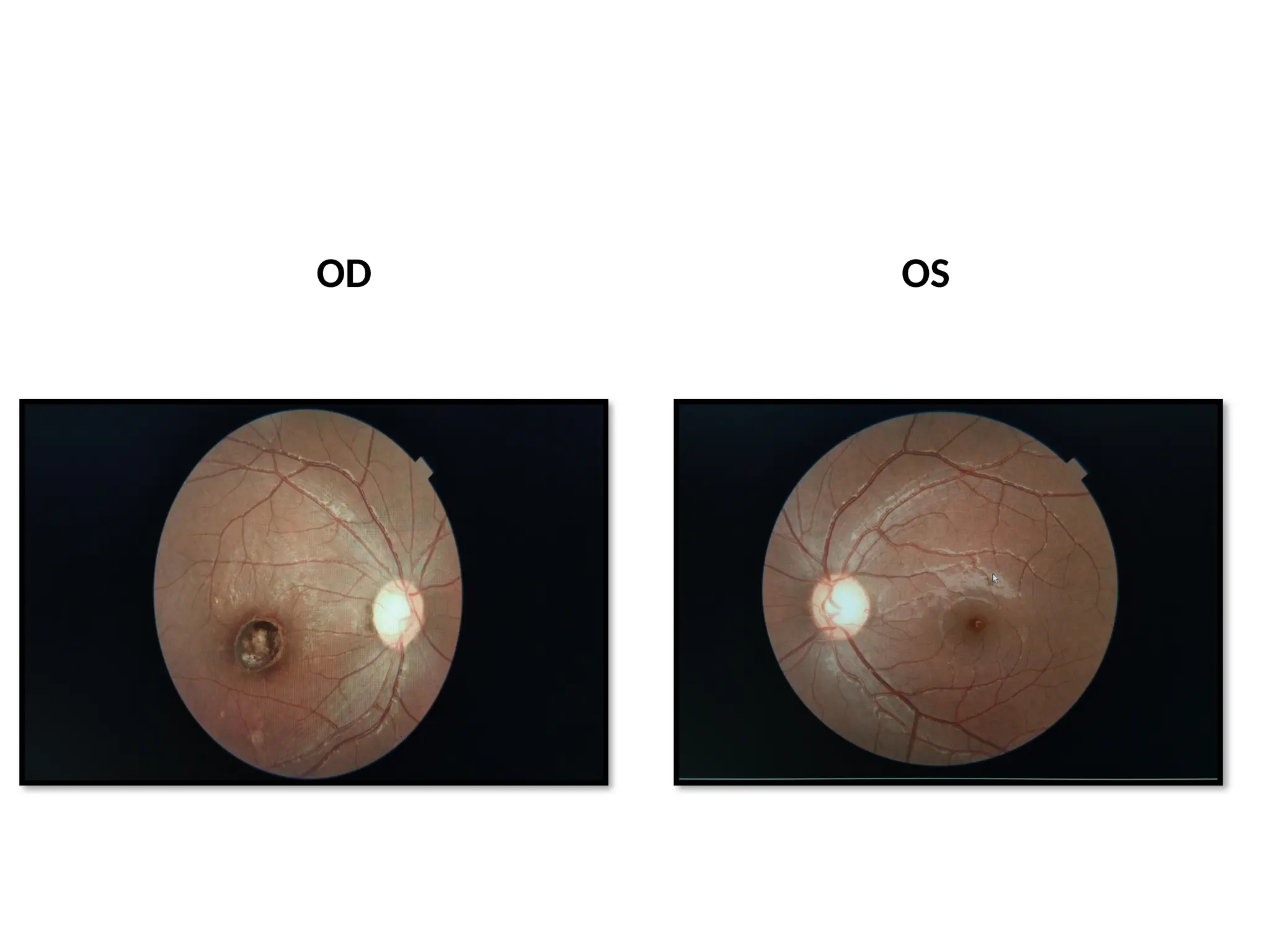 retinal scar case presentation by one of | PPTX