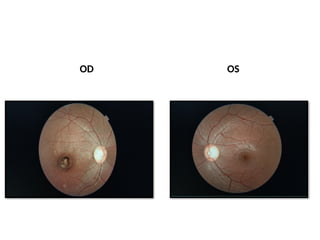 retinal scar case presentation by one of | PPTX