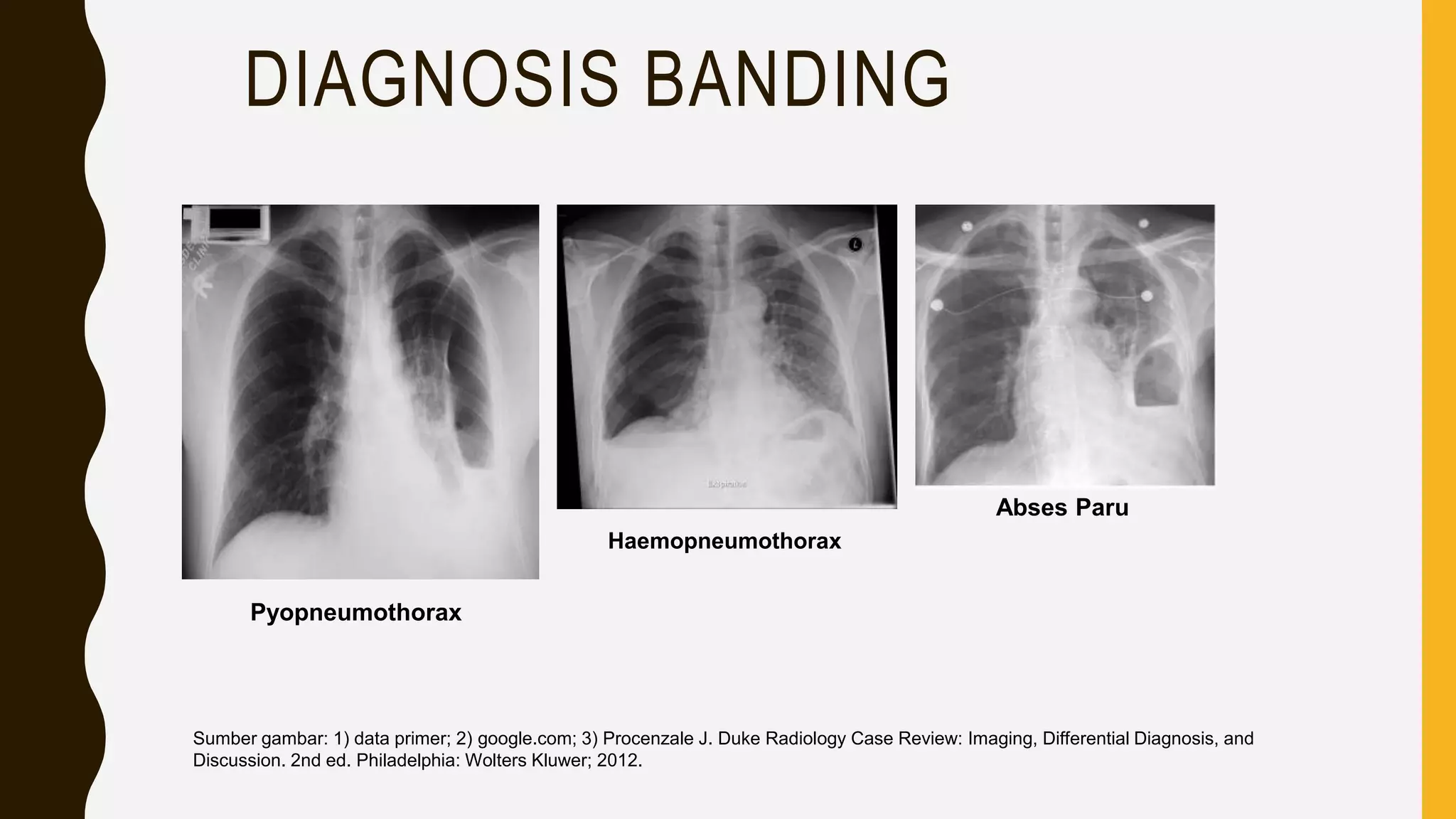 CRS Hidropneumotoraks.pptx