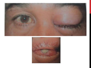 Crs selulitis orbita | PPTX