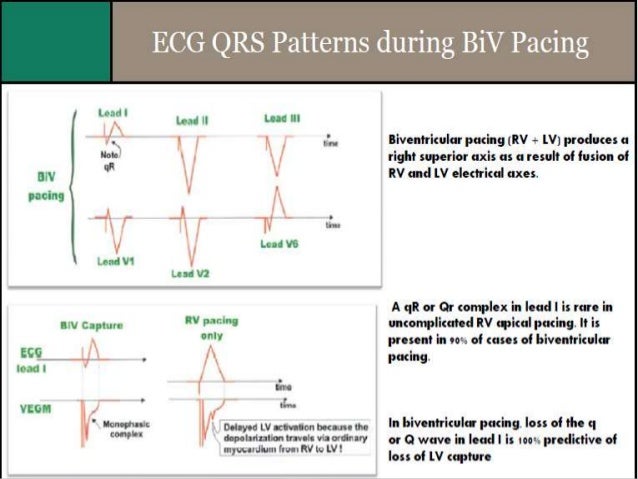 ECG interpretation postCRT