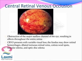 Central Retinal Vein OcclUsIon (CRUISE) Study - Cruise trial | PPTX