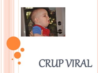 Crup, Traqueitis bacteriana y Epiglotitis | PPTX