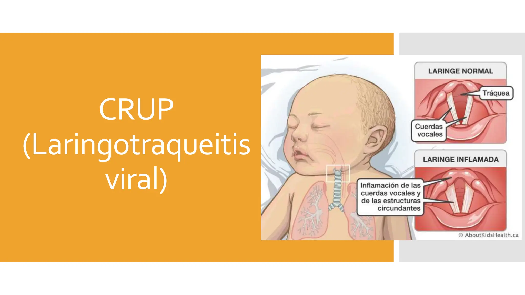 enfermedad de CRUP (Laringotraqueitis) en pediatria | PPTX
