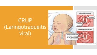 enfermedad de CRUP (Laringotraqueitis) en pediatria | PPTX