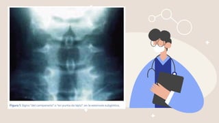 crup laringitis viral o laringotraqueitis | PDF