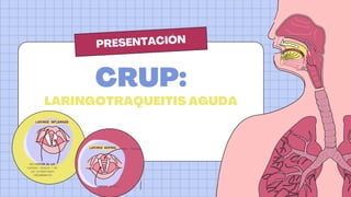 CRUP o laringotraqueitis aguda definición diagnóstico y manejo | PDF