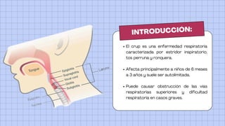 CRUP o laringotraqueitis aguda definición diagnóstico y manejo | PDF