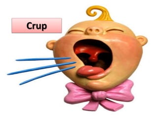 Crup | PPTX