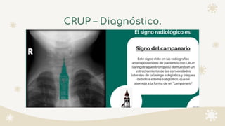 crup viral 2021 definición, Etiología, fisiopatología | PDF