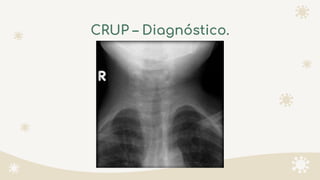 crup viral 2021 definición, Etiología, fisiopatología | PDF