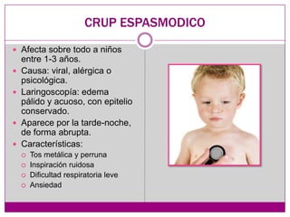 Crup, Epiglotitis y CE.pdf pediatría lll | PDF