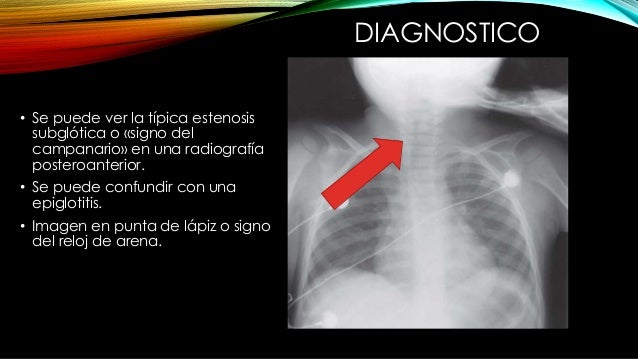 Crup laringotraqueitis epiglotitis 22