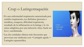 CRUP O LARINGOTRAQUEITIS AGUDA.pdfdassad | PDF