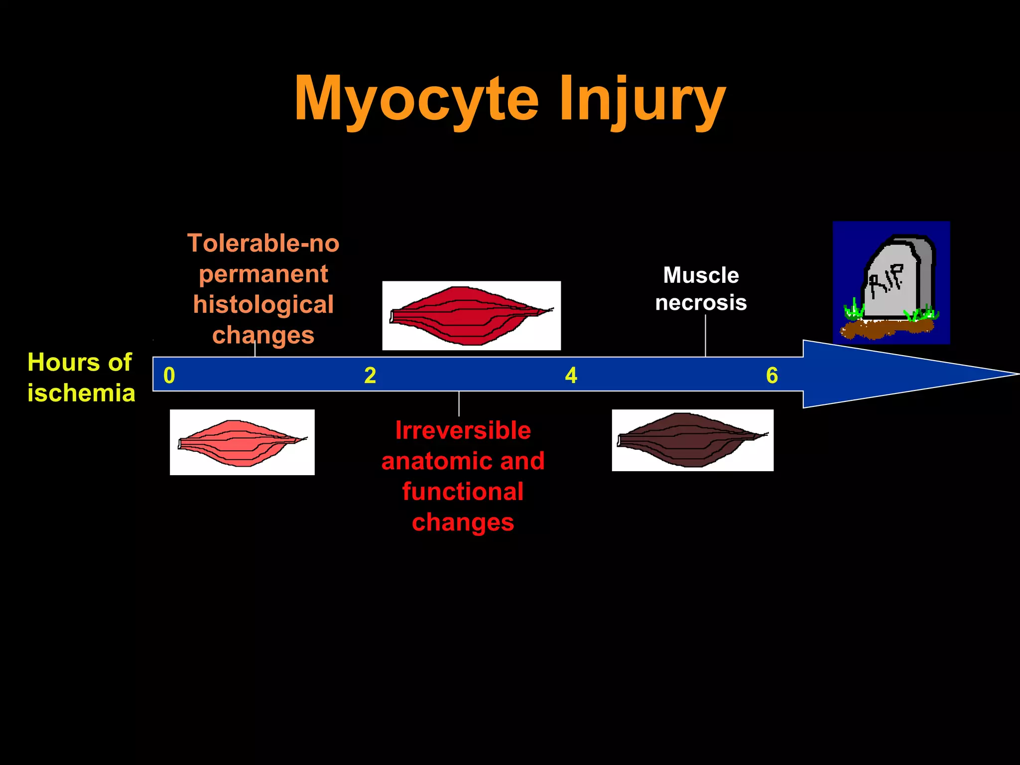 Crush injury-rhabdomyolysis | PPT