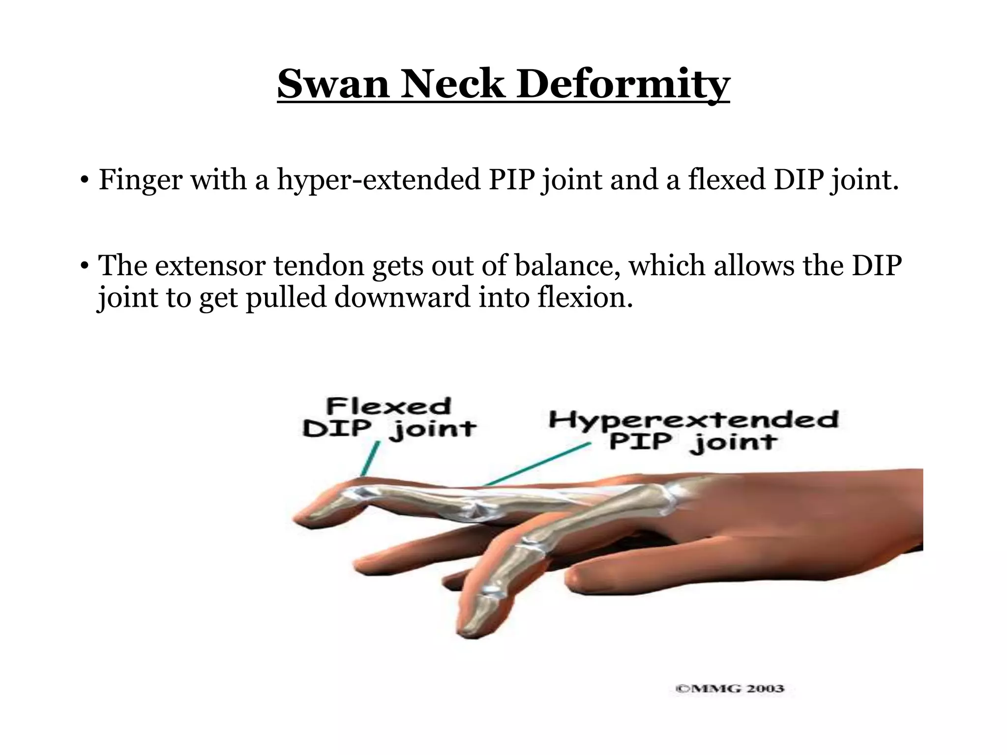 Crush injuries of hand | PPTX