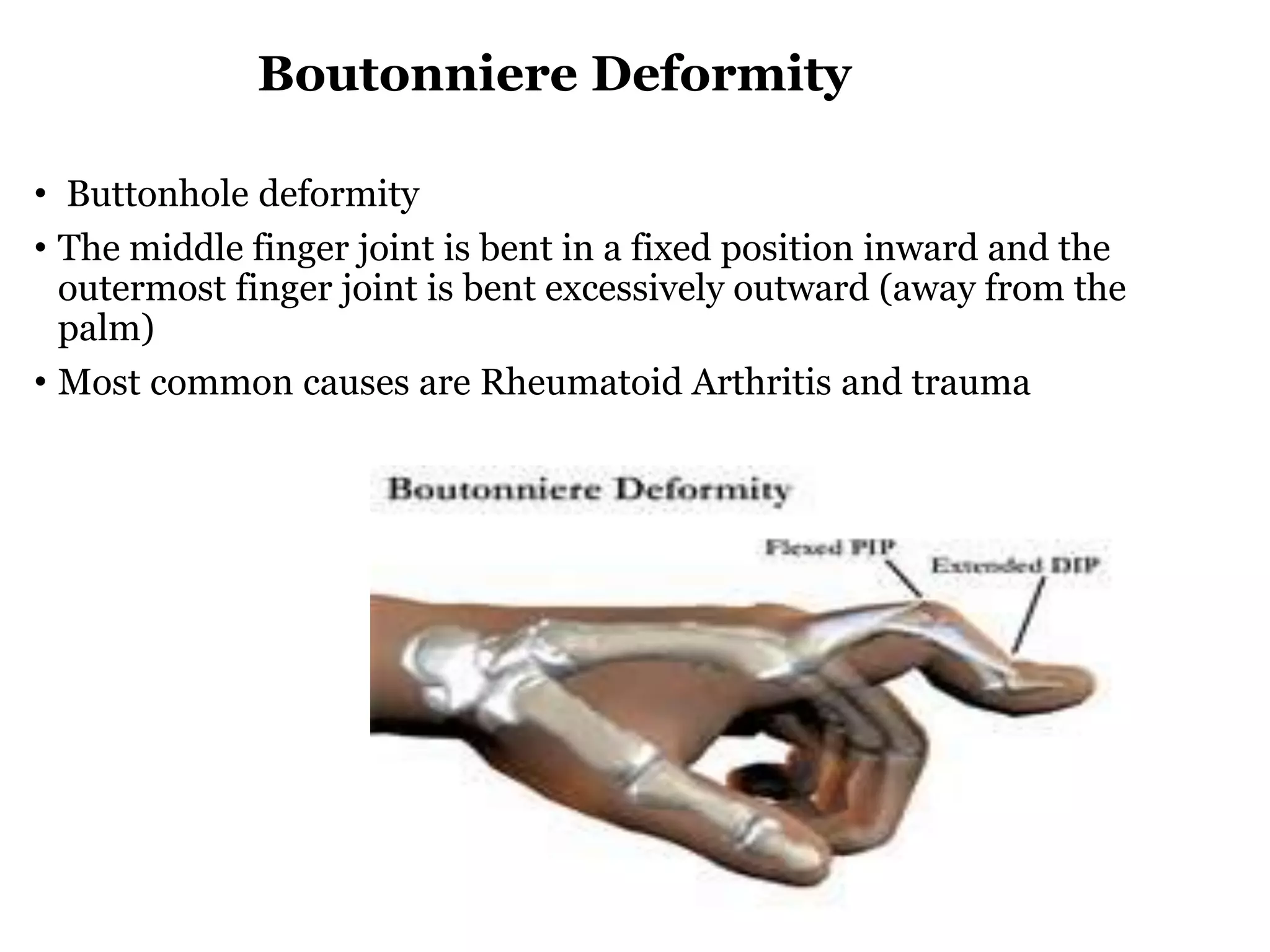 Crush injuries of hand | PPTX