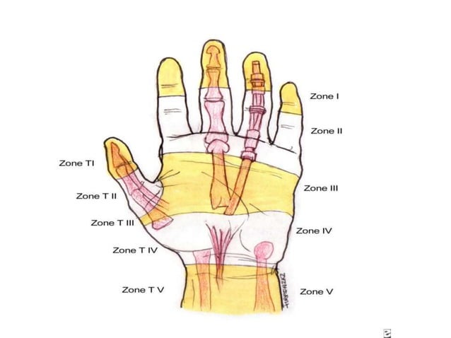 Crush injuries of hand | PPTX
