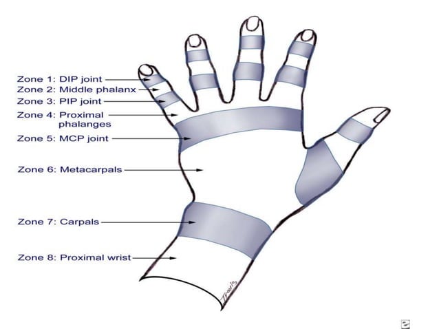 Crush injuries of hand | PPTX