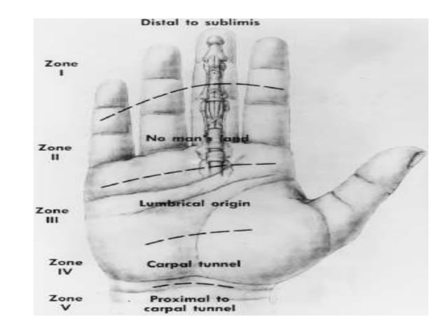 Crush injuries of hand