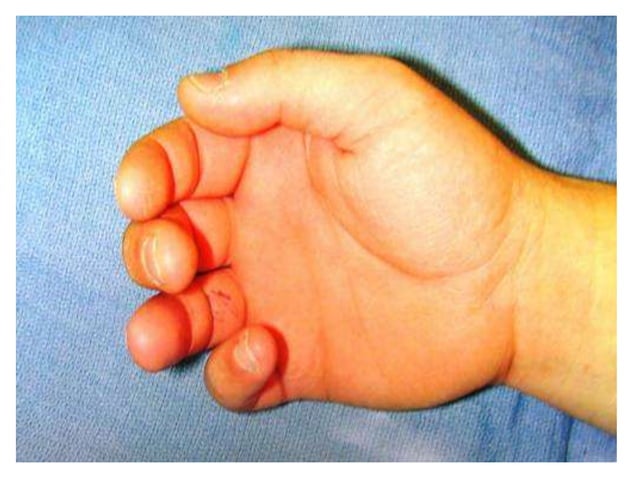 Crush injuries of hand