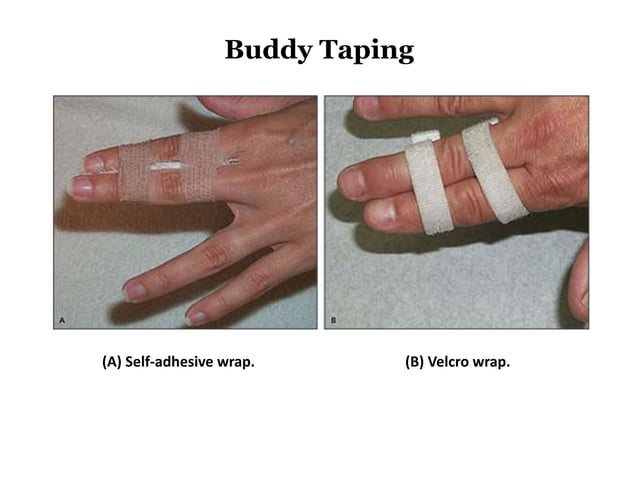 Crush injuries of hand