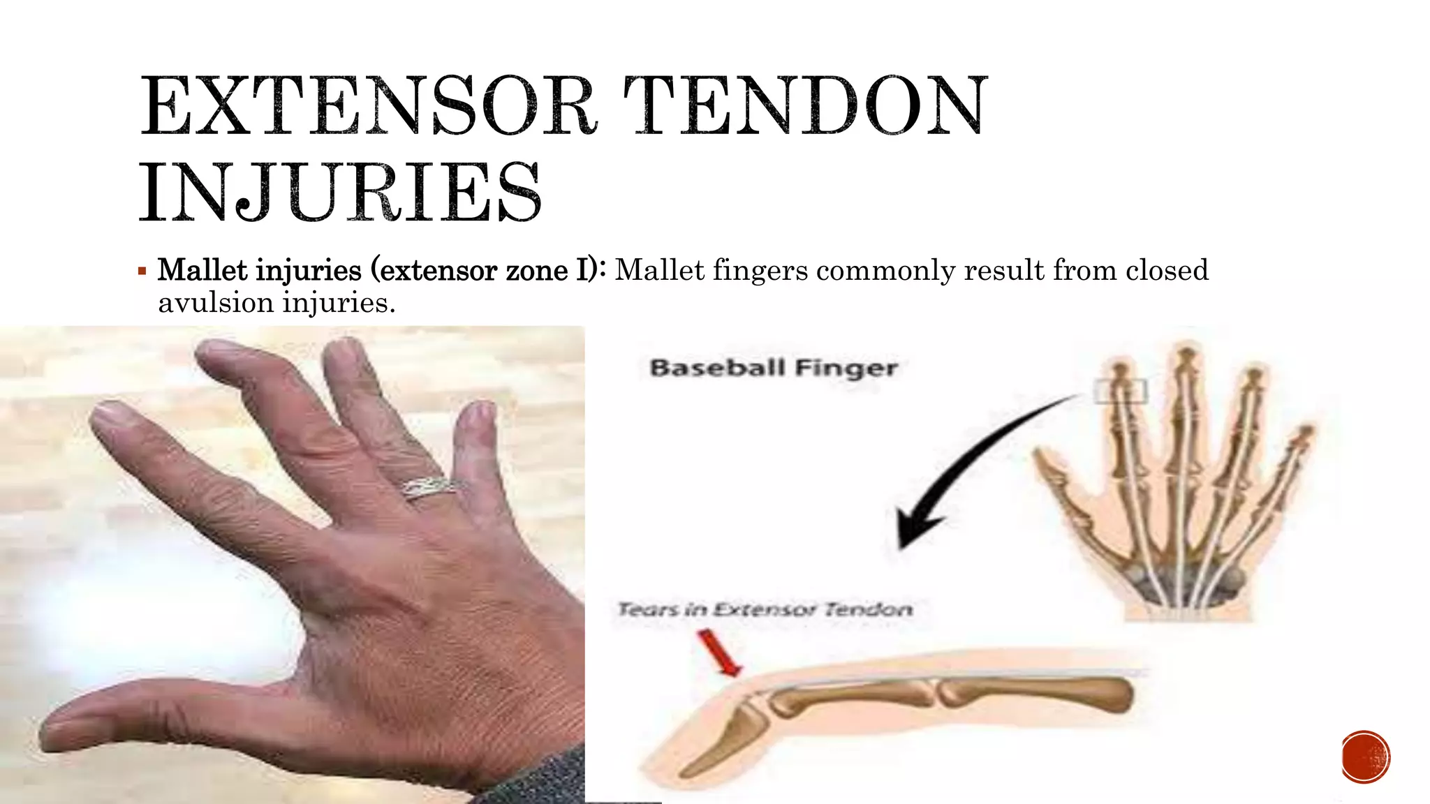 CRUSH INJURIES OF THE HAND.ppt