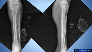 COM_crushed mangled tibia | PPT