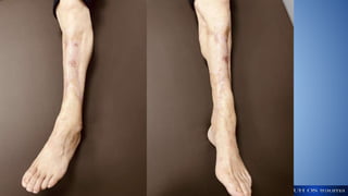 COM_crushed mangled tibia | PPT