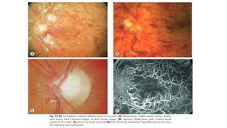 CRVO-TYPES & PATHOPHYSIOLOGY-OPHTHAL PG | PPTX