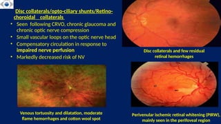 CENTRAL RETINAL VEIN OCCLUSION . RETINA. | PPTX