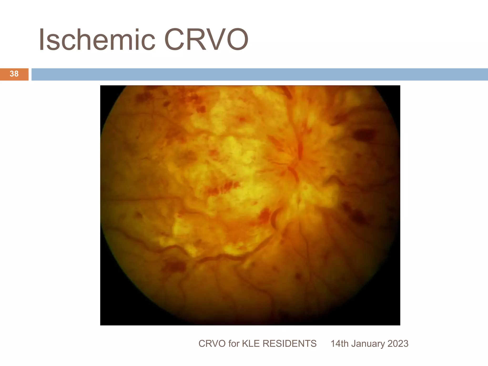 DR WANI'S TALK ON CRVO FOR RESIDENTS KLE 14 JAN 2023.pptx | Eye and ...