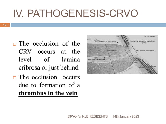DR WANI'S TALK ON CRVO FOR RESIDENTS KLE 14 JAN 2023.pptx | Eye and ...